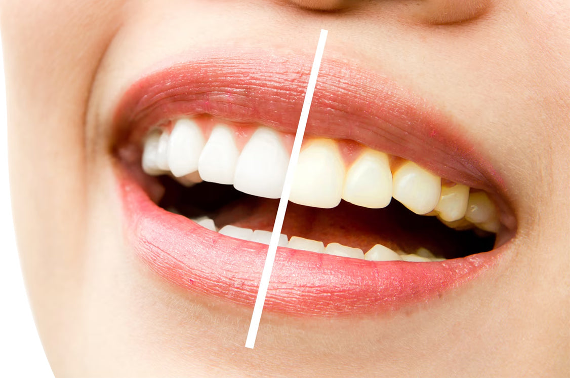 Brighten Smiles, Brighten Your Practice with Teeth Whitening – Colgate ...